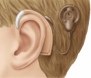 Cochlear Implants - Auditory Implant Service